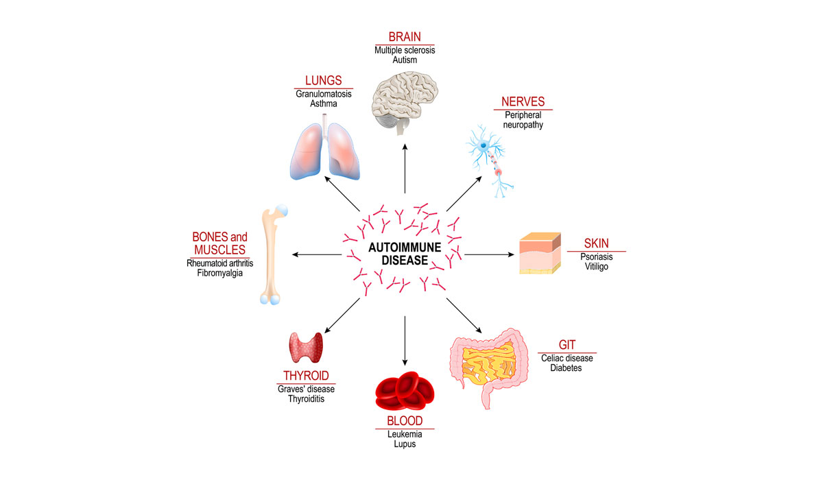Autoimmune Disease - RYZE